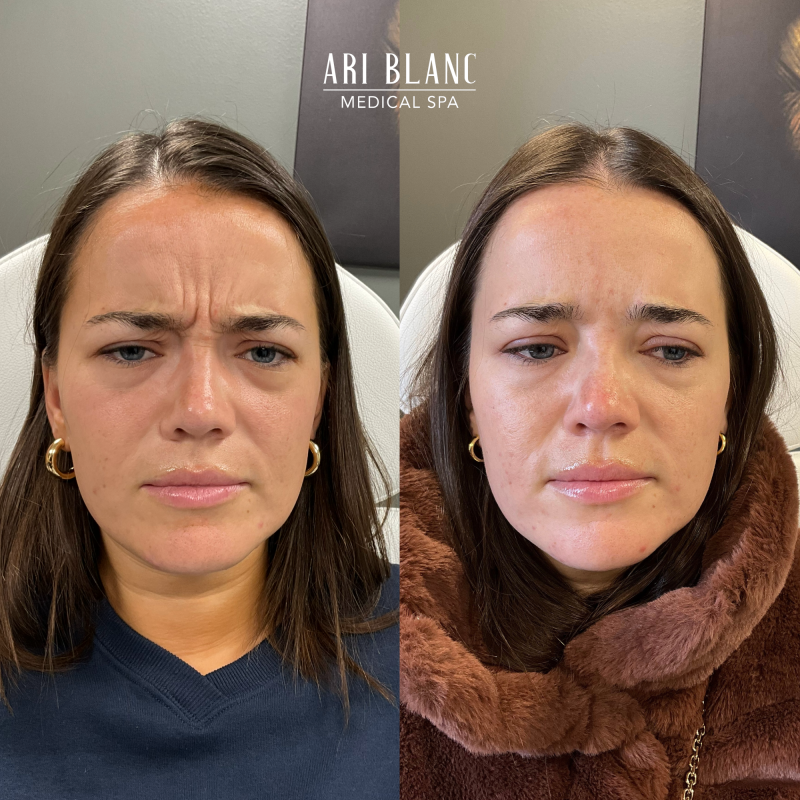 Before & After Photos | Philly Medspa - Ari Blanc Medical Spa