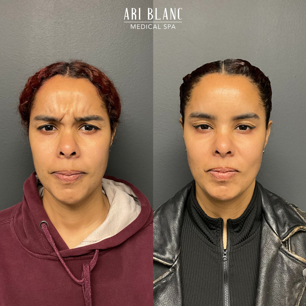 Before & After Photos | Philly Medspa - Ari Blanc Medical Spa