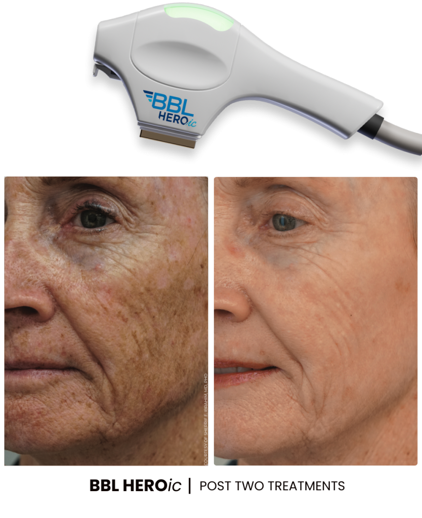 Get Radiant with BBL HEROic & MOXI – Ari Blanc Medical Spa