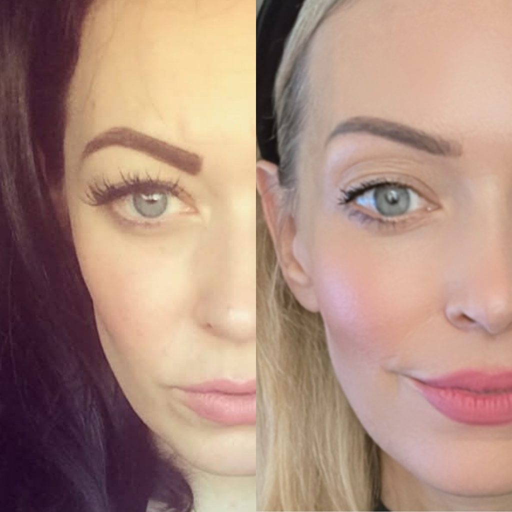Discover Sculptra: How I Restored My Face’s Natural Volume – Ari Blanc ...
